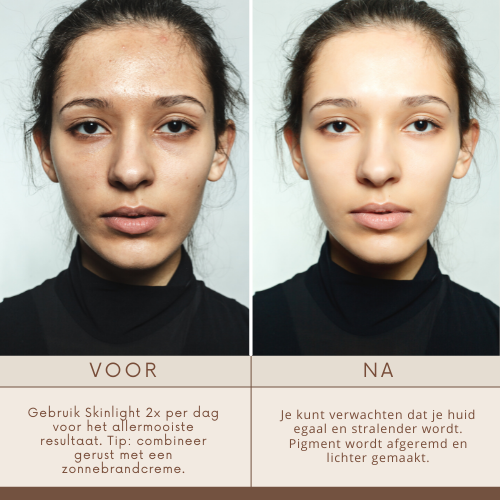 Huid bleken voor en na - Huidbleken